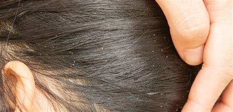 The Consequences Of Leaving Dead Nits In Your Hair How To Remove Nits Licefreee