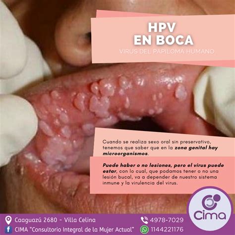 Verrugas En La Lengua