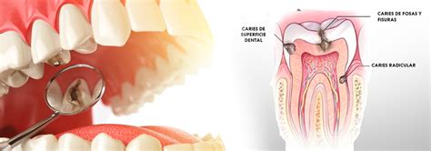 ¿en Qué Consiste La Caries Radicular Clínica Dental Santos Pilarica