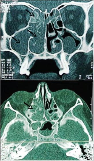 Sinus Ct Scans Revealed Lesions With Soft Tissue Density In The Right