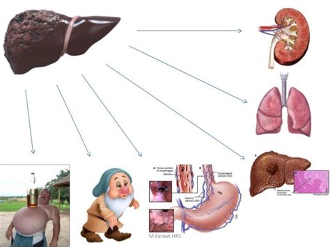 Hepatorenal Syndrome