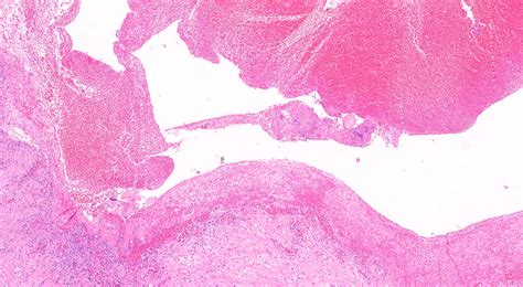 Pancreatic Pseudocyst Histology