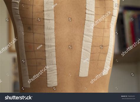 Patch Test Allergic Reaction Allergic Contact Foto Stok 796656331