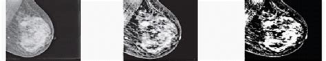 Mammogram Image Segmentation A Original Image B Proposed Download Scientific Diagram