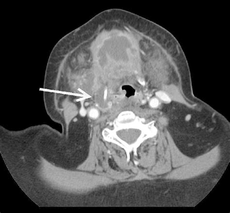 What Does A Soft Tissue Neck Ct Scan Show Ct Scan Machine Images
