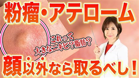 しこり小さな粉瘤をそのまま放置してしまうと YouTube