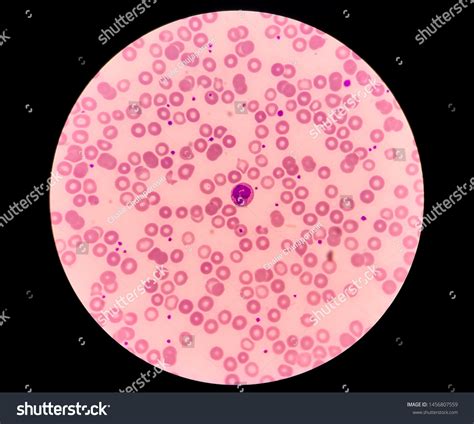 Anemia Peripheral Blood Smear🕙 Descubra Slots Honor