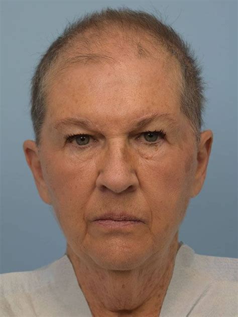 Before And After Direct Neck Lift Houston Face Forward