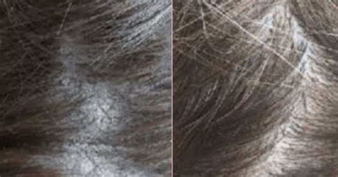 The Ultimate Guide To Dry Scalp Treatment Effective Home Remedies For