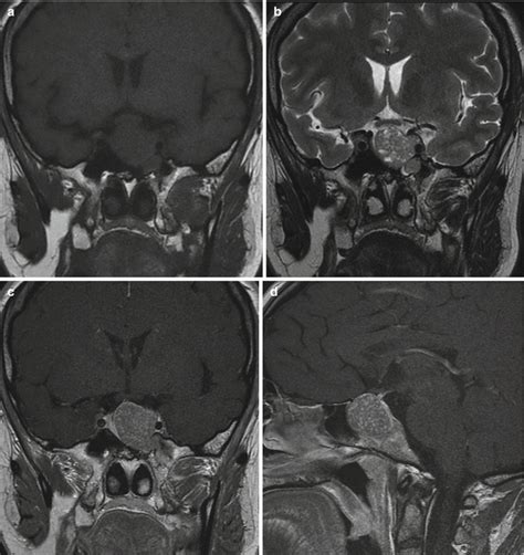 Endoscopic Endonasal Transsphenoidal Approach Neupsy Key