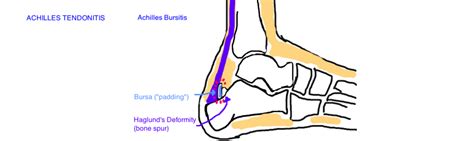 Foot Achilles Tendonitis — Bone Talks