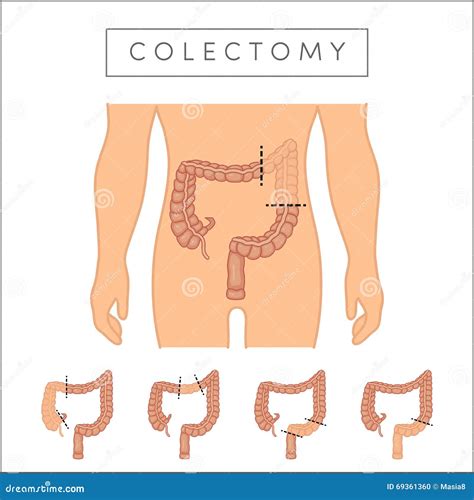 Types Of Colectomy Stock Illustration Illustration Of Large 69361360