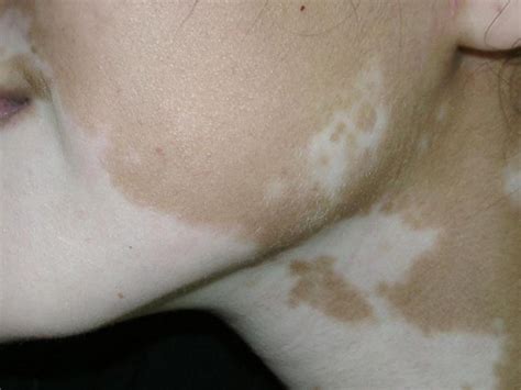 Hypopigmentation Disorders Ppt Download