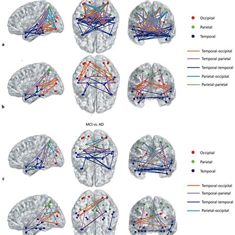 The Connection Differences Between NC And MCI As Well As MCI And AD A Download Scientific
