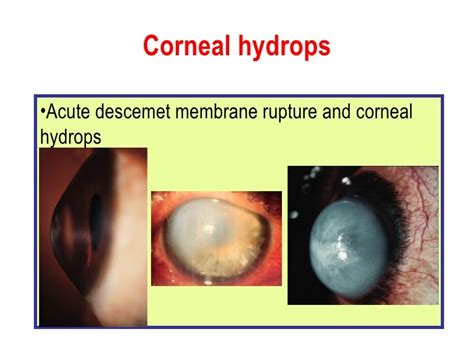 Retinoscopy In Keratoconus At June Blackwell Blog