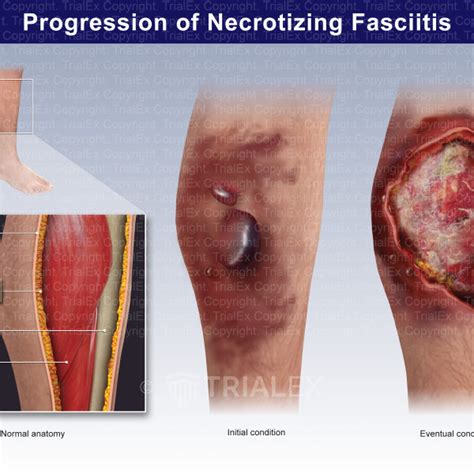 Early Necrotizing Fasciitis