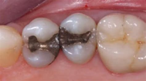 Which Technique Is Best Total Etch Self Etch Or Selective Etch