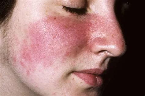 Hiv And Aids Rashes And Skin Conditions