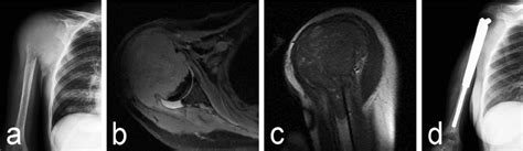 Preoperative Ap Radiograph A And Mri Slices B C Of A Gctb Of