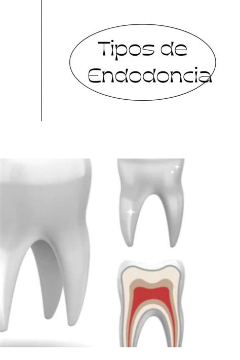 Vector De Un Molar Mostrando La Pulpa Dental Root Canal Different