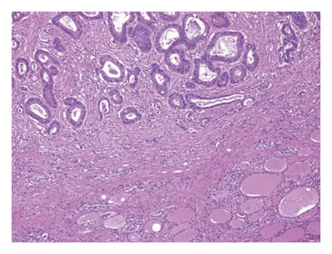 Pathologic Examination Of The Excised Mass Hematoxylin And Eosin