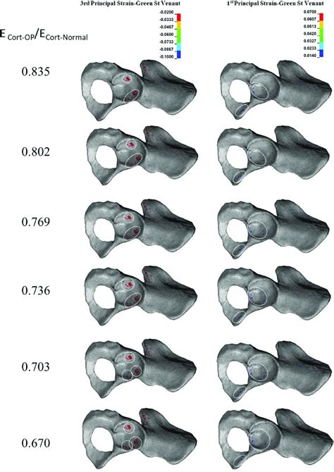 Effect Of Reduction In Cortical Elastic Modulus Due To Osteoporosis Download Scientific Diagram
