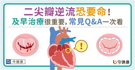 二尖瓣逆流恐要命，及早治療很重要！常見qa一次看