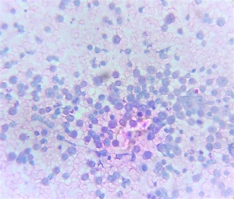 FNAC Shows Sheets Of Small Round Cells With Increased Nuclear Cytoplasm