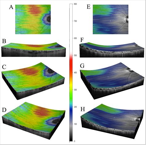 Choroidal Volume Variations With Age Axial Length And Sex In Healthy