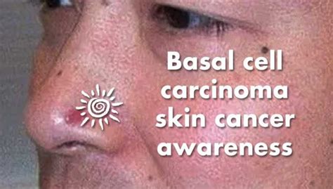 Skin Cancer Symptoms Nose