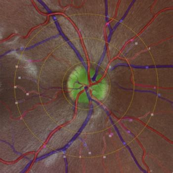 Automatisierte Messung der retinalen Gefäßweiten mit Bestimmung der AV