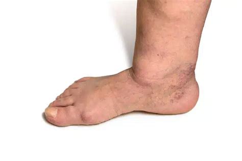 Identifying Early Signs Of Diabetic Foot Problems What To Watch For