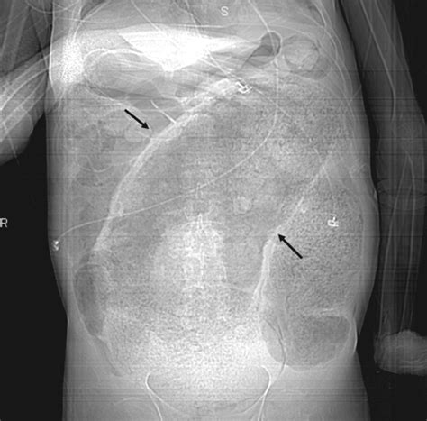 Fecal Impaction