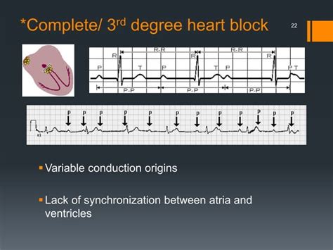 Defibrillation Cardioversion And Pacing Pptx