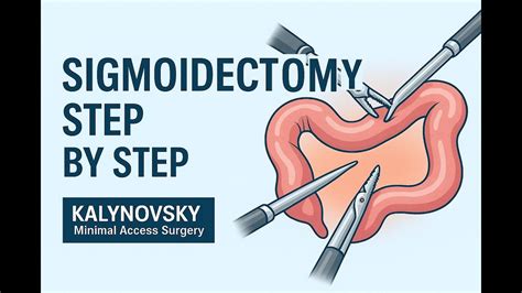Laparoscopic Sigmoidectomy With Tme Step By Step Surgical Technique