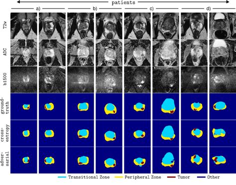 Adversarial Networks For Prostate Cancer Detection