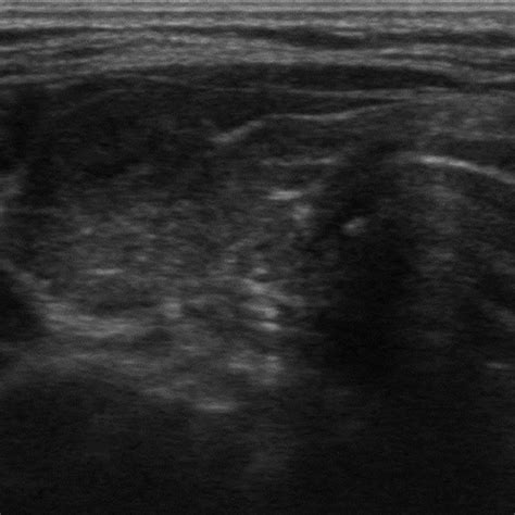 Exophytic Nodule Is Located On The Anterior Surface Of The Right Lobe Download Scientific