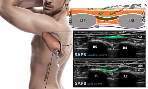 Húmedo Puede Soportar Culpa Serratus Anterior Nerve Block Absorción