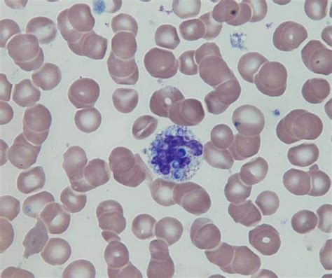 Pin De Carolina Hernández En Hematología Hematología
