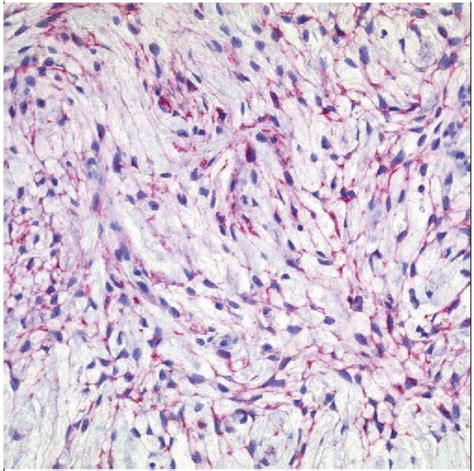 Perineurioma Basicmedical Key
