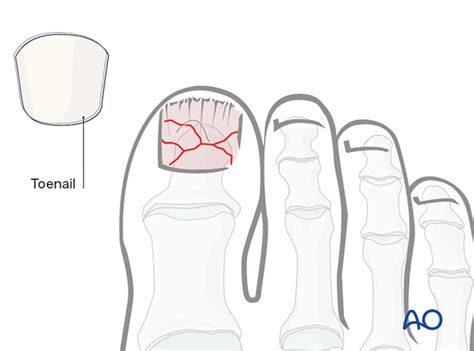 Nail Bed Excision For Lesser Toe Fractures