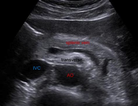 Pancreas Ultrasound Flashcards Quizlet