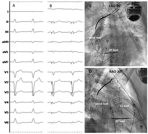 Conduction System Pacing For Cardiac Resynchronization Therapy