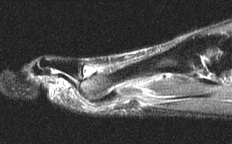 Figure 2 Pre Operative Mri