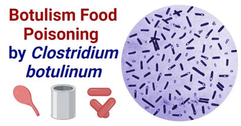 Clostridium Botulinum An Overview Sciencedirect Topics 43 Off