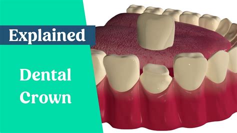 Dental Crown Procedure Explained Youtube