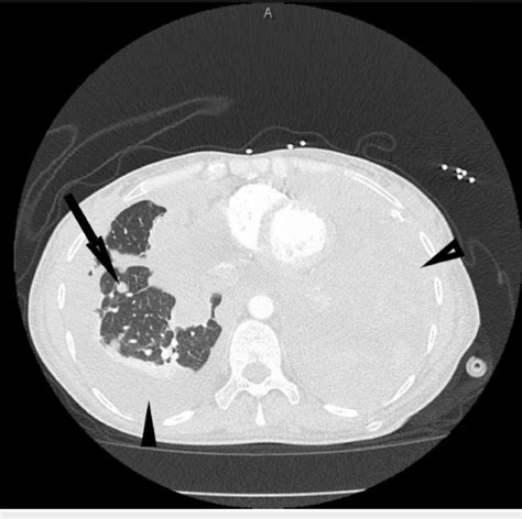 Ct Scan Of Axial Section Showing Loculated Malignant Fluid Collections