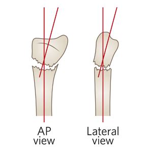 Clinical Practice Guidelines Distal Radius And Or Ulna Metaphyseal