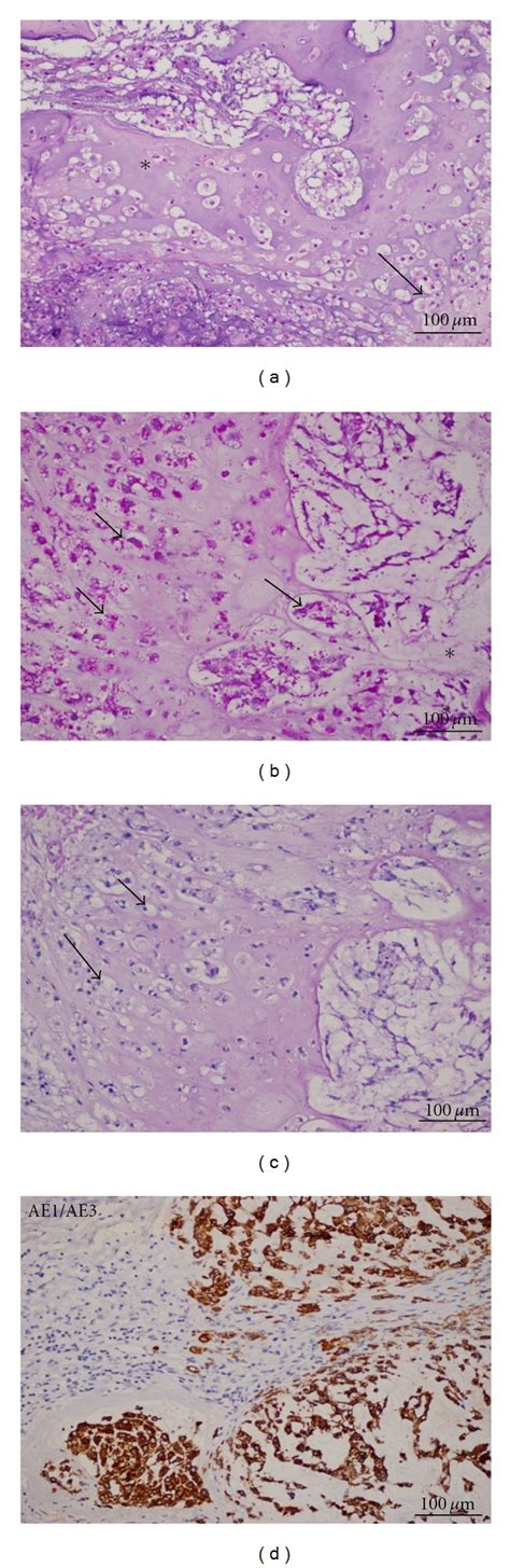 A Photomicrograph Demonstrating The Typical Chordoma Cells With