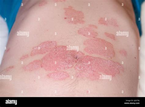 Acute Psoriasis On The Stomach In A Man Severe Redness On The Skin An